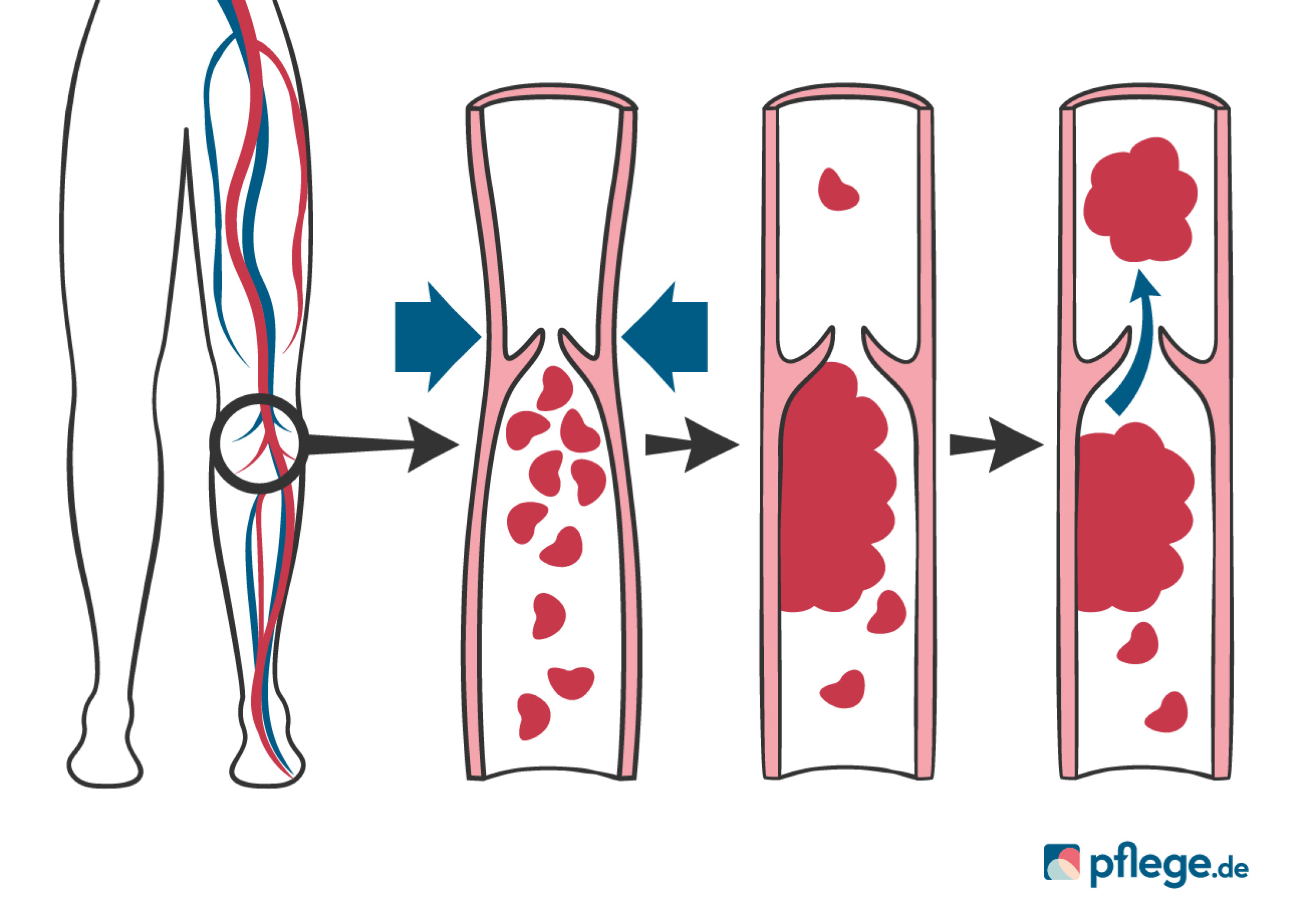 Thrombose » Definition, Arten, Ursachen, Folgen & Behandlung