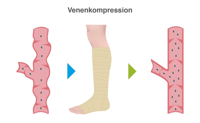 Ulcus cruris (offenes Bein) » venosum & arteriosum | pflege.de